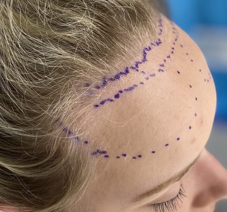 Plastic Surgery Case Study - Female Forehead Reshaping with Frontal ...