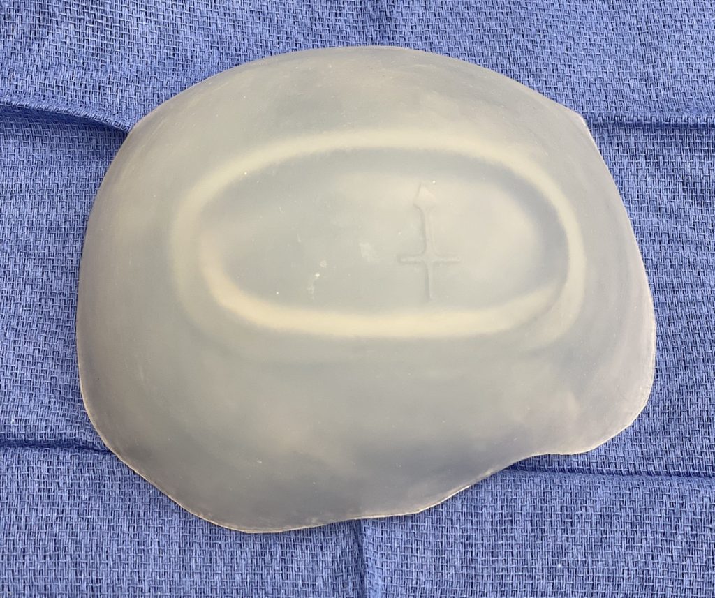 Plastic Surgery Case Study - Combined Head Reshaping with Custom Back ...