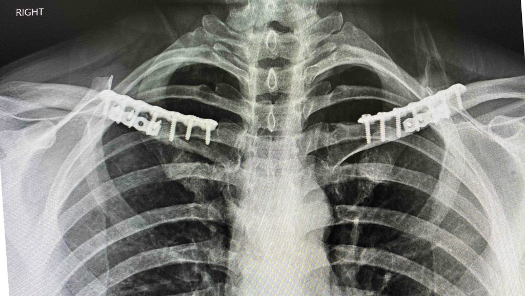 Plastic Surgery Case Study - Large Clavicle Bone Removals in Shoulder ...