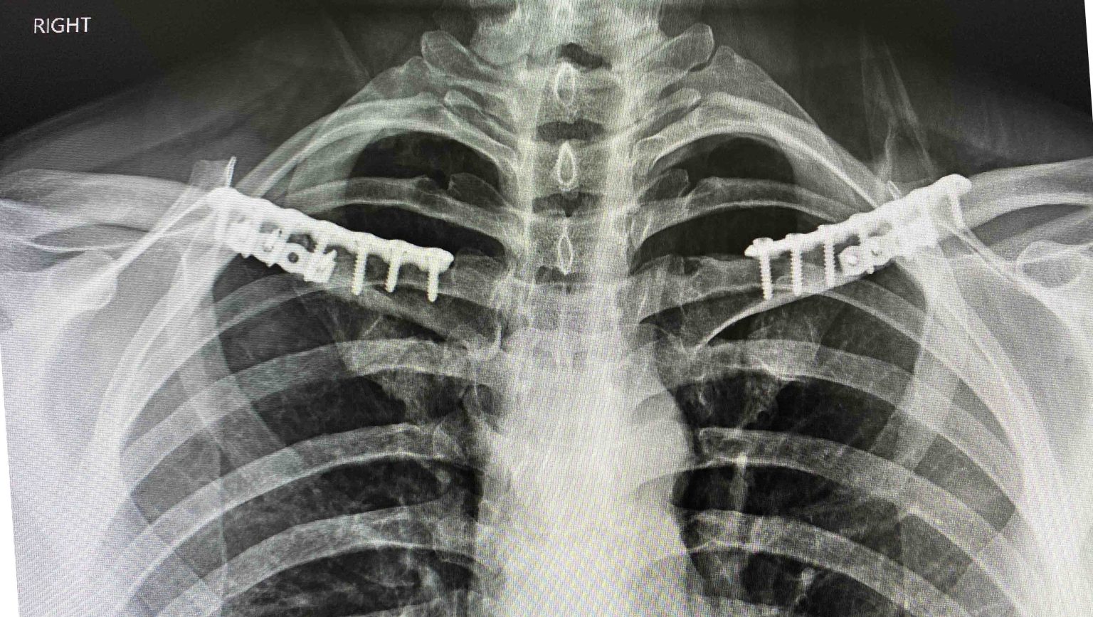 Plastic Surgery Case Study - Large Clavicle Bone Removals in Shoulder ...