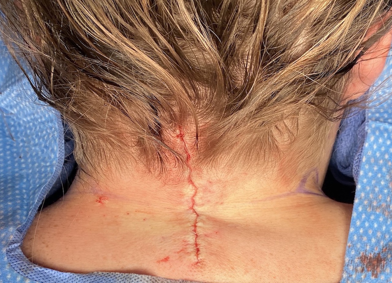 Plastic Surgery Case Study - Posterior Webbed Neck Correction With ...