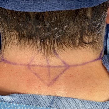 webbed neck surgery Archives - Explore Plastic Surgery