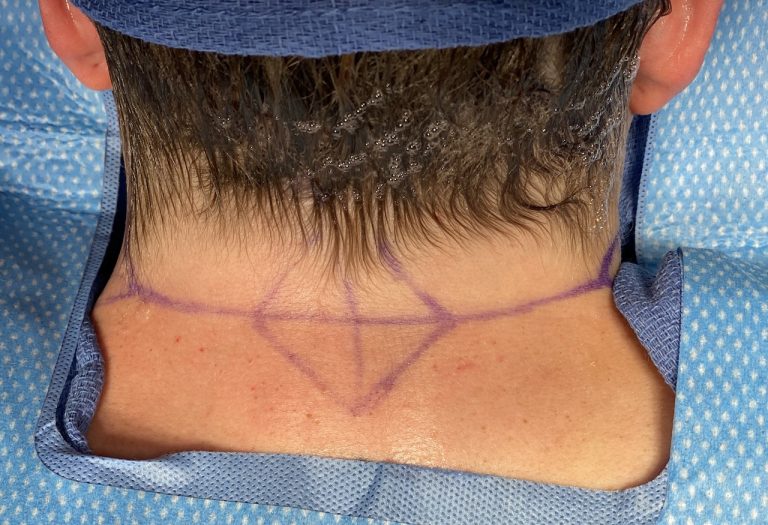 female webbed neck surgical markings Dr Barry Eppley Indianapolis ...