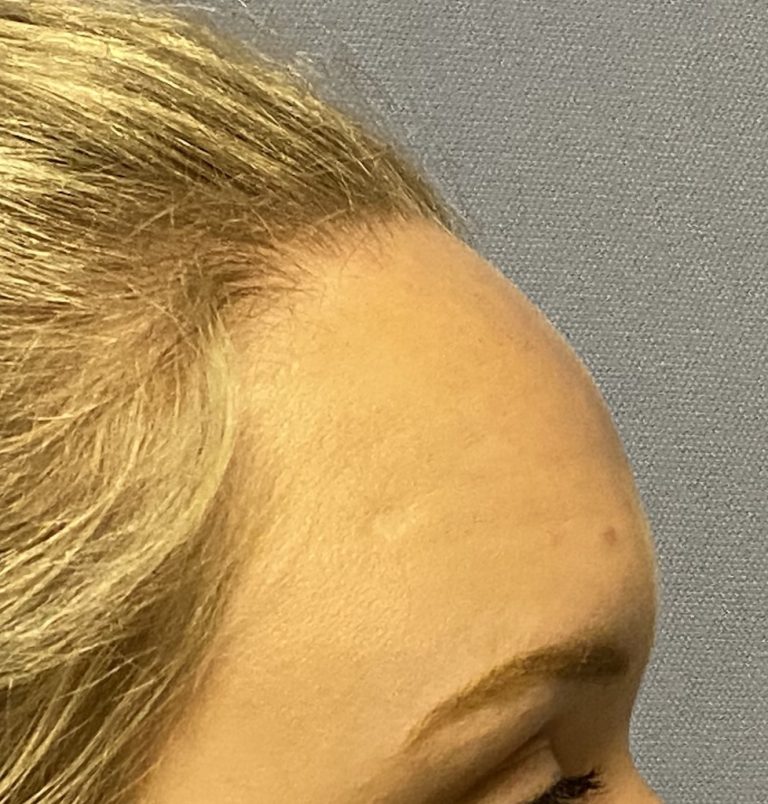 high and overly wide female forehead side view Dr Barry Eppley ...