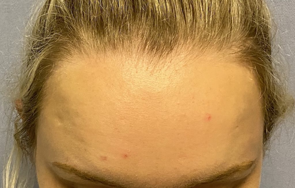 Plastic Surgery Case Study - Female Forehead Reshaping with Frontal ...