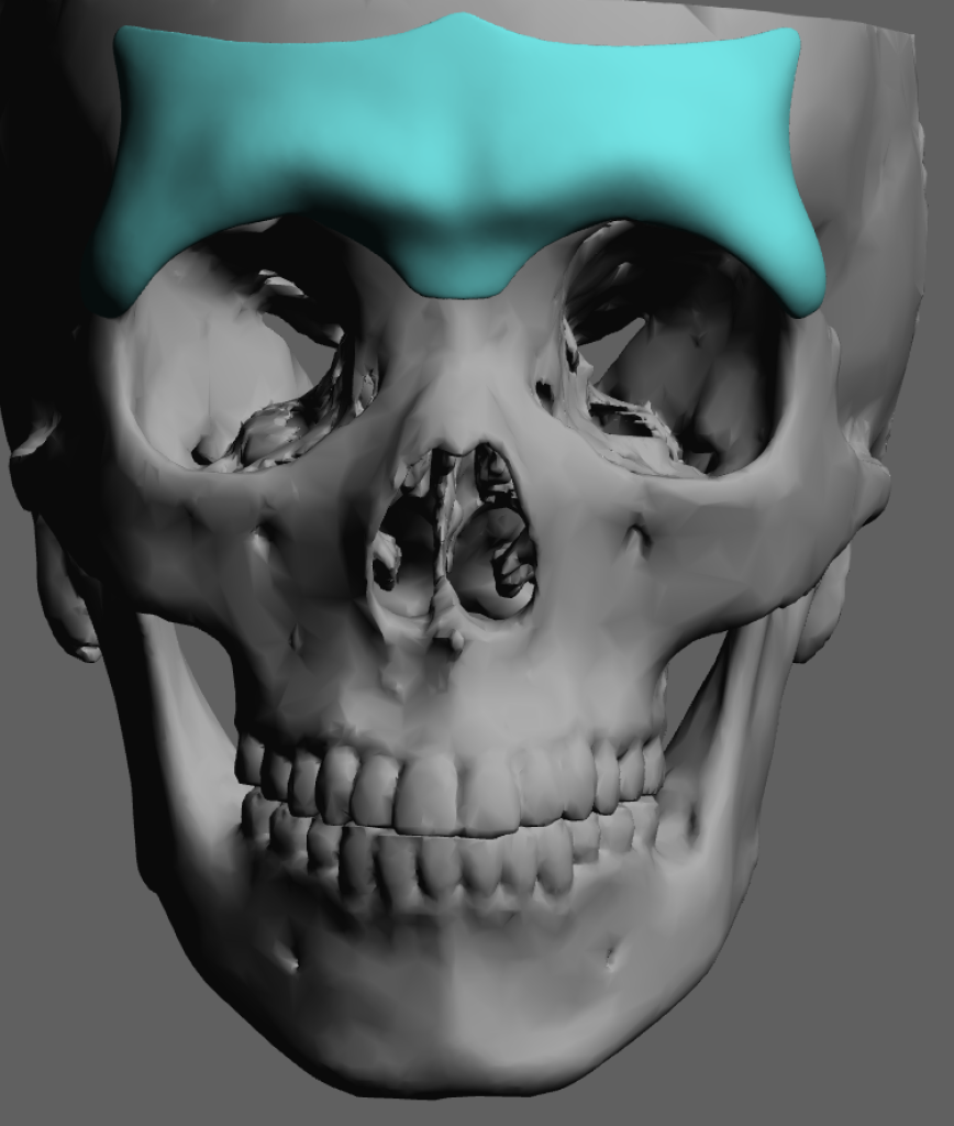 male brow bone implant design front view Dr Barry Eppley Indianapolis ...