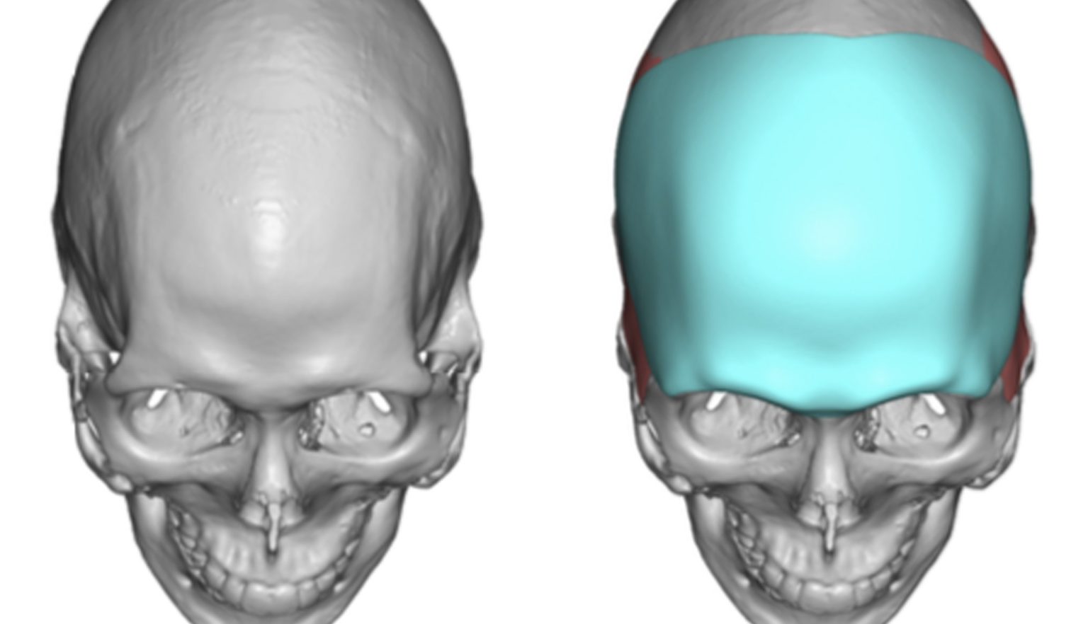 Plastic Surgery Case Study - Male Custom Forehead - Brow Bone Implant ...