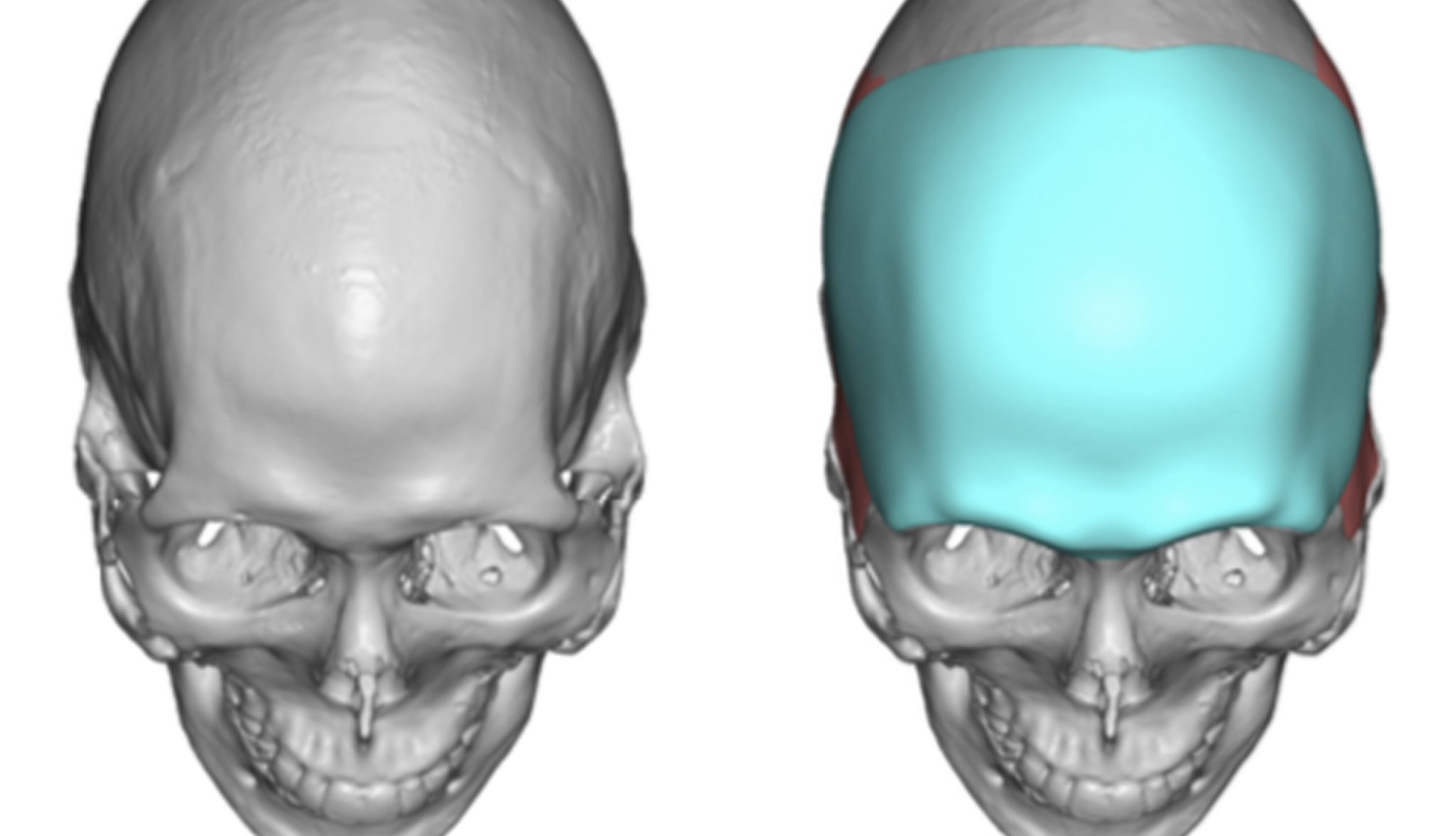 Plastic Surgery Case Study - Male Custom Forehead - Brow Bone Implant ...