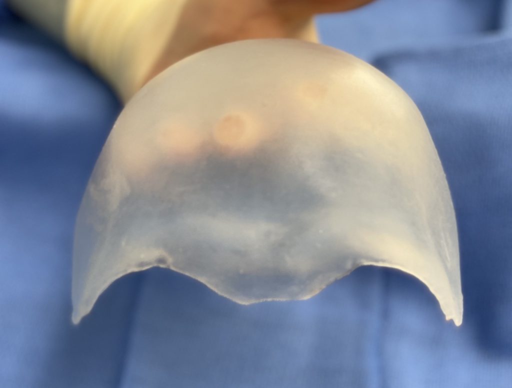 Plastic Surgery Case Study - Male Custom Forehead - Brow Bone Implant ...