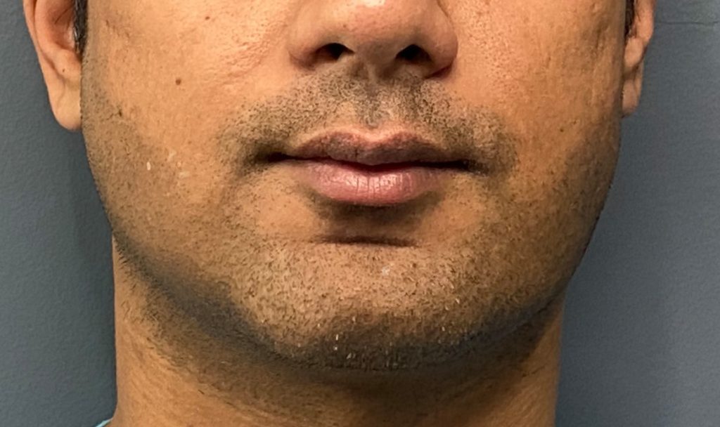 Plastic Surgery Case Study - Total Lower Jaw Augmentation With A ...