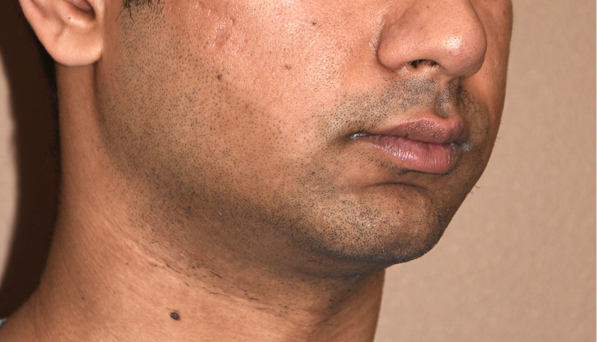 Plastic Surgery Case Study - Total Lower Jaw Augmentation With A ...