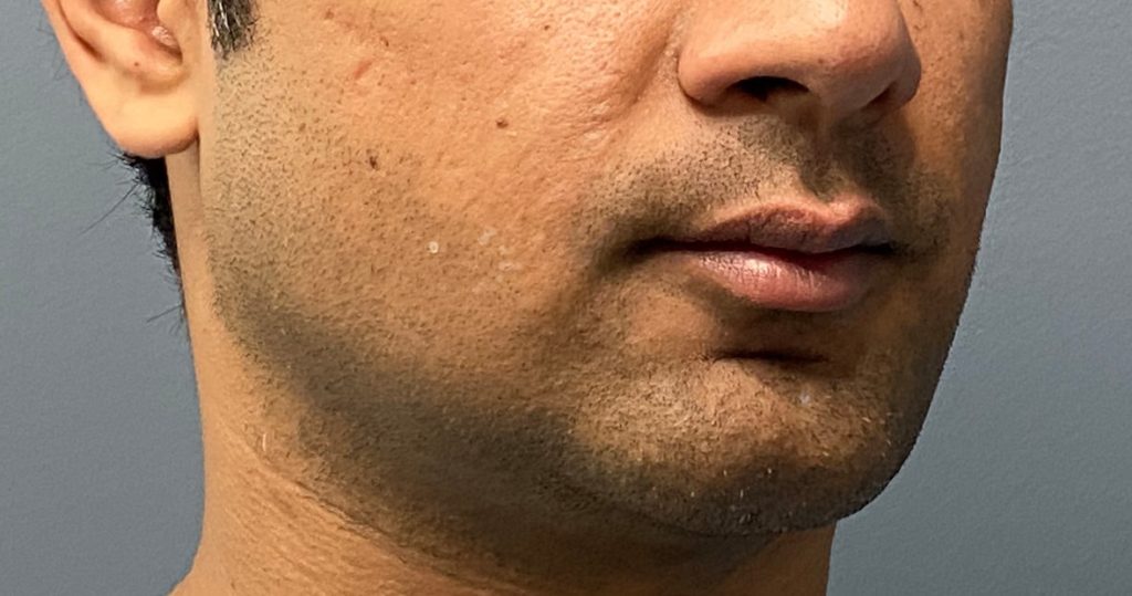 Plastic Surgery Case Study - Total Lower Jaw Augmentation With A ...