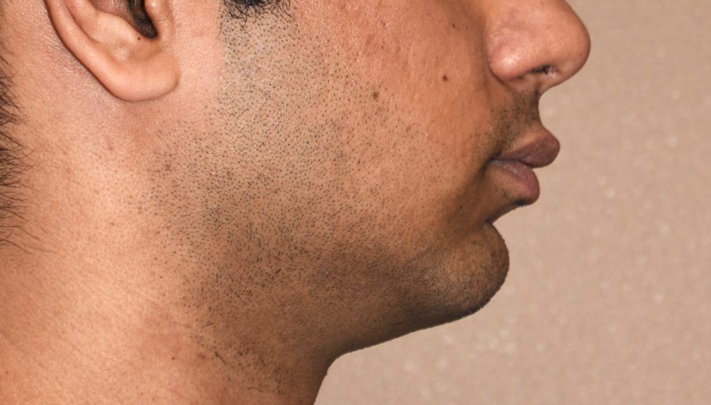 Plastic Surgery Case Study - Total Lower Jaw Augmentation With A ...