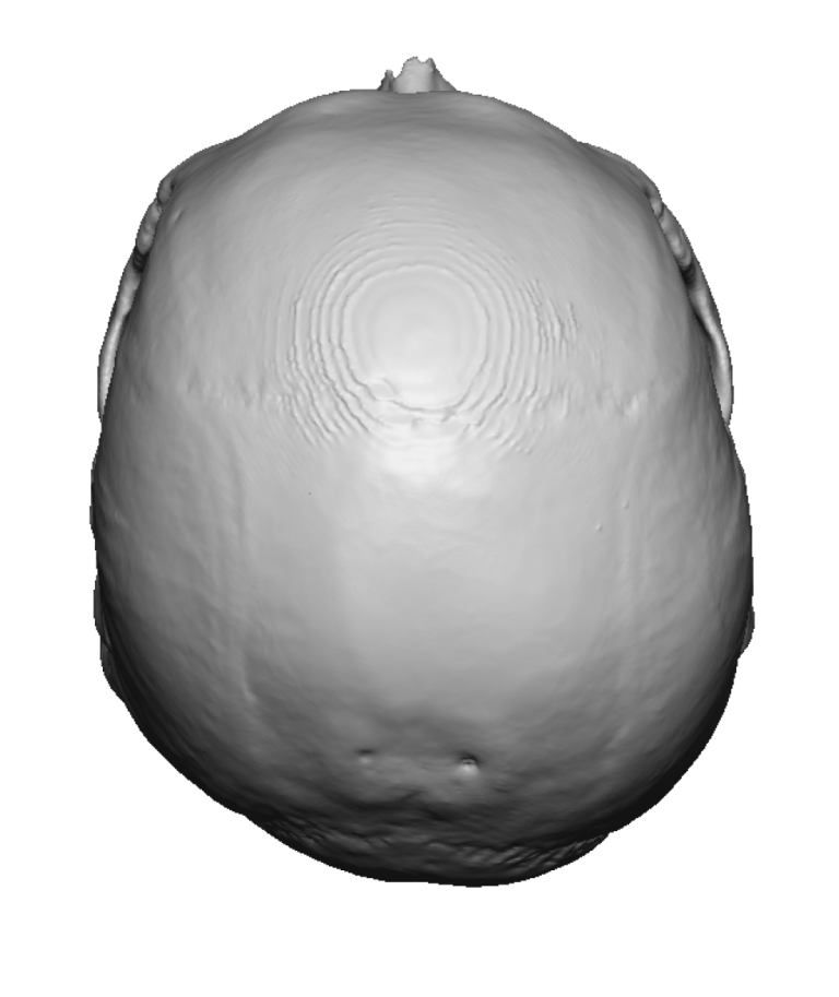 Plastic Surgery Case Study - Combined Head Reshaping with Custom Back ...