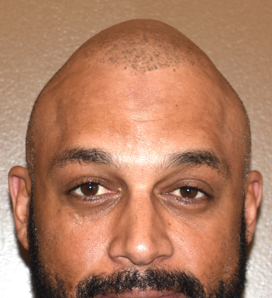 Plastic Surgery Case Study - Five Year Long Term Correction of the ...