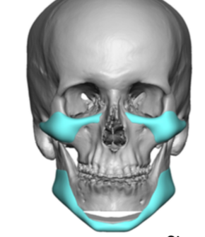 male vertical bony chin lengthening with custom jaw implants design ...