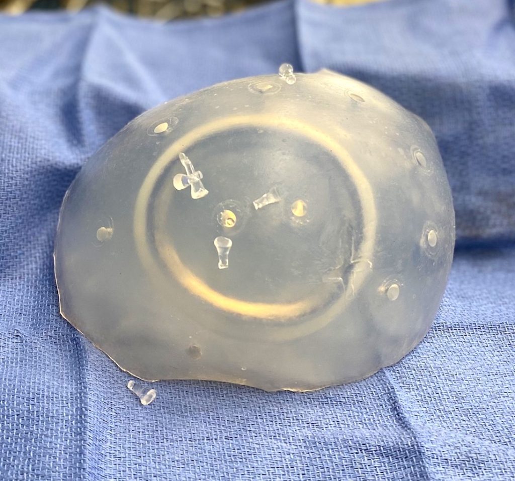 Plastic Surgery Case Study - Custom Skull Implant For The Correction Of ...