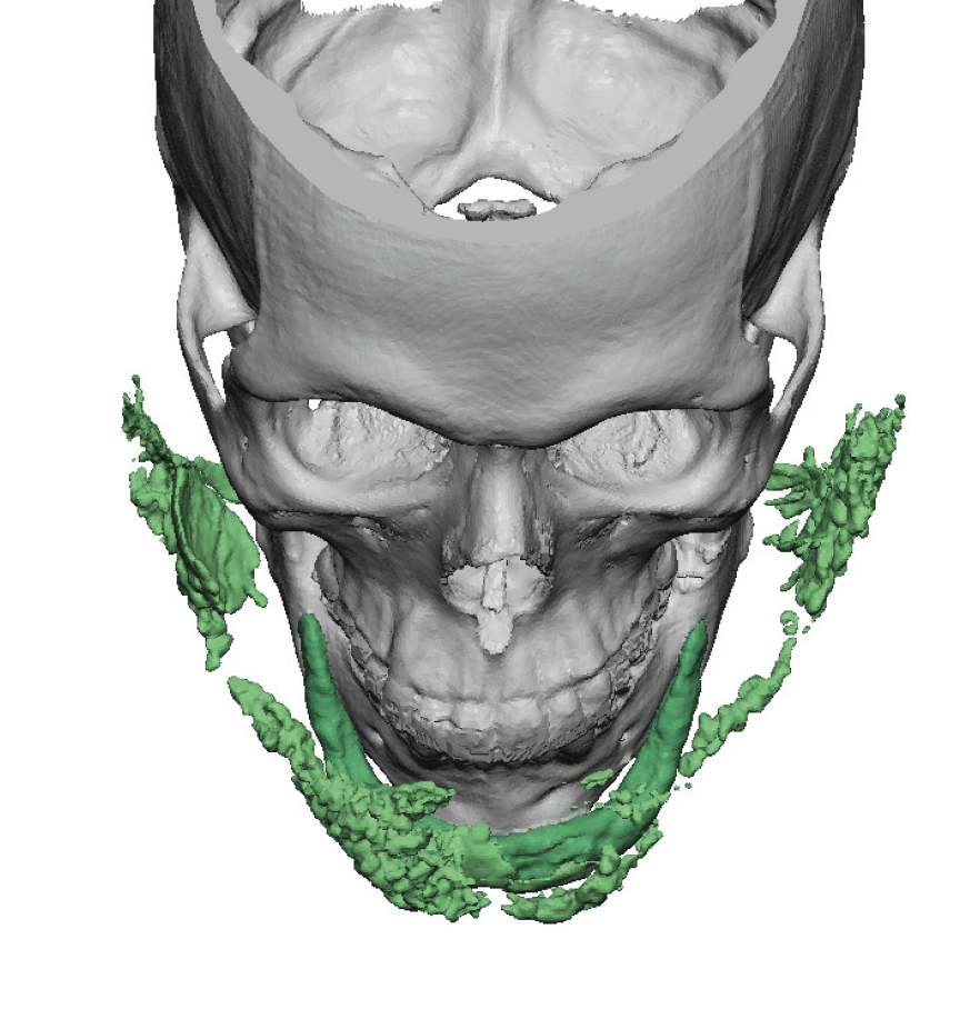 radiesee jawline injectable filler 3D CT scan top view Dr Barry Eppley ...