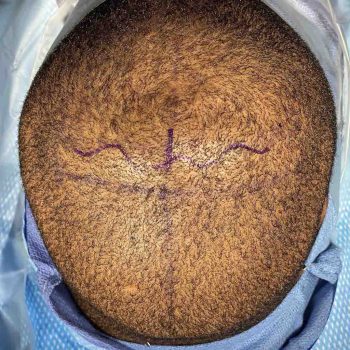 skull reshaping Archives - Explore Plastic Surgery