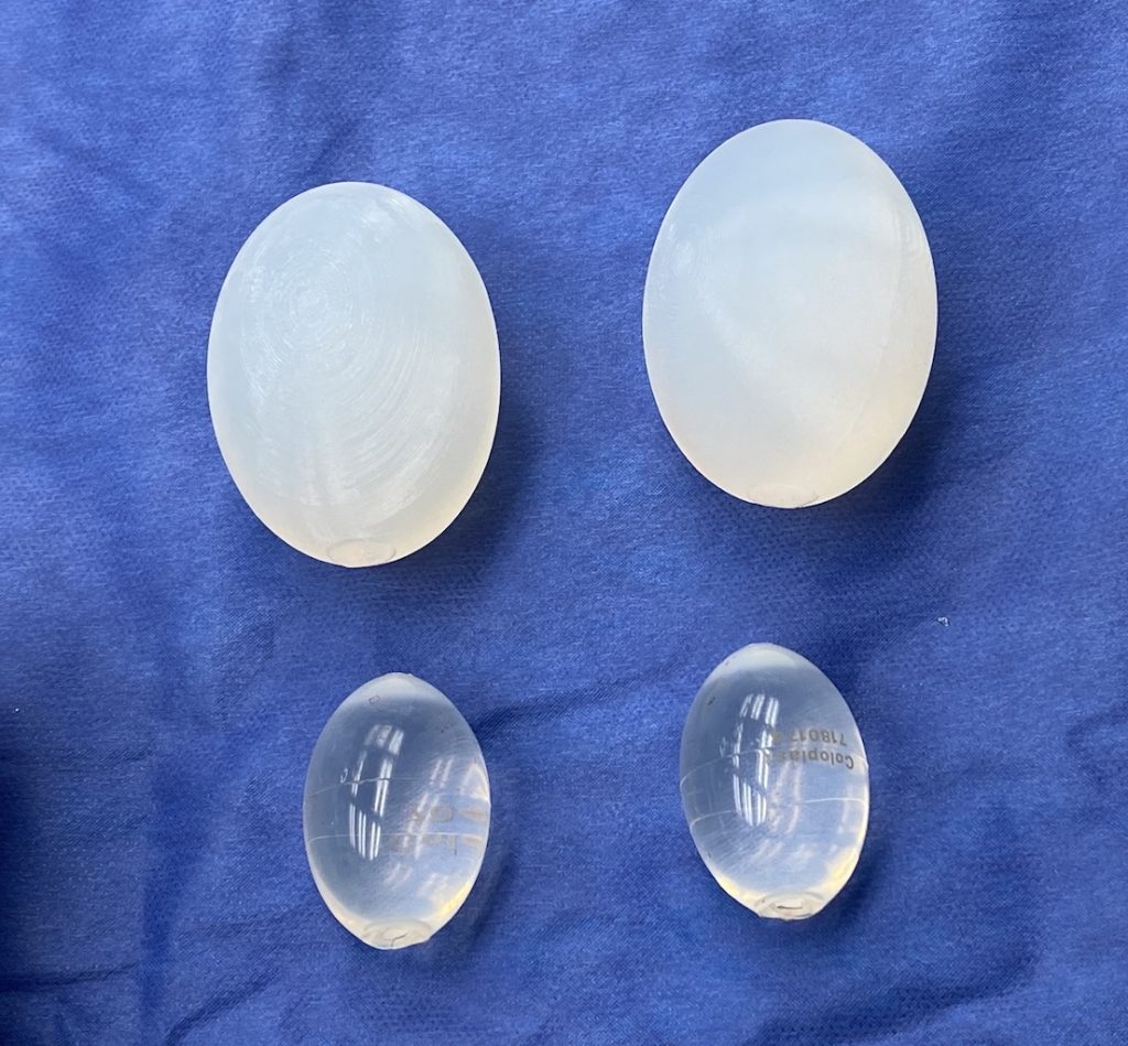 Plastic Surgery Case Study - Secondary Ultrasoft Silicone Testicle ...