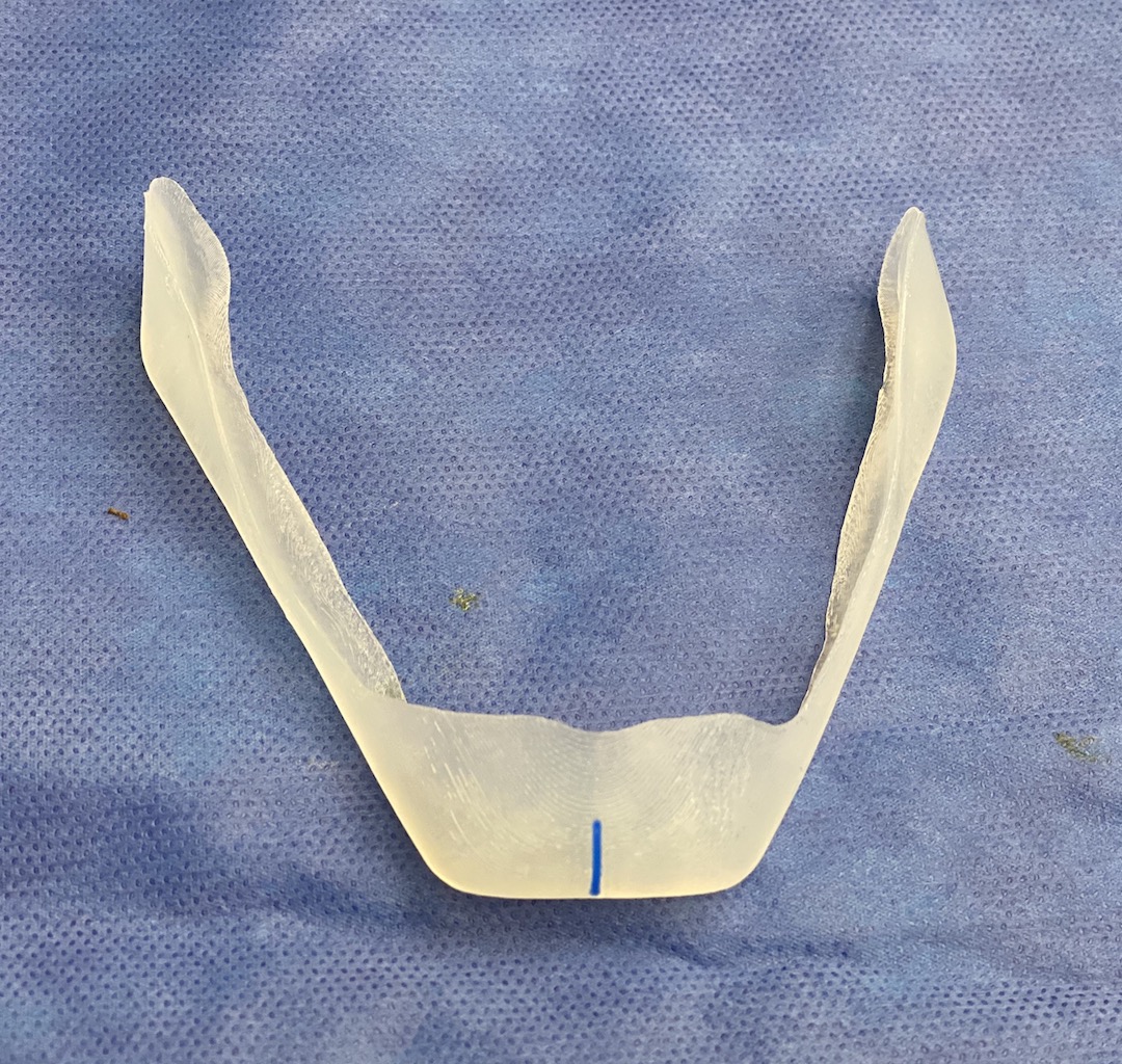 Technical Strategies - The Midline Chin Positioning Guide in Custom ...