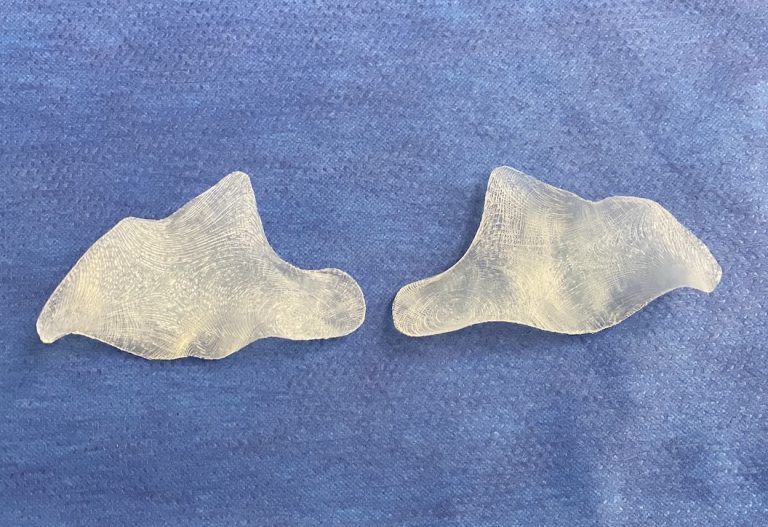 Plastic Surgery Case Study - Completion Custom Paranasal-Maxillary ...