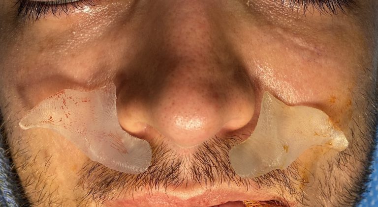 Plastic Surgery Case Study - Completion Custom Paranasal-Maxillary ...