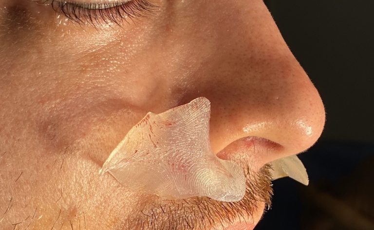 Plastic Surgery Case Study - Completion Custom Paranasal-Maxillary ...