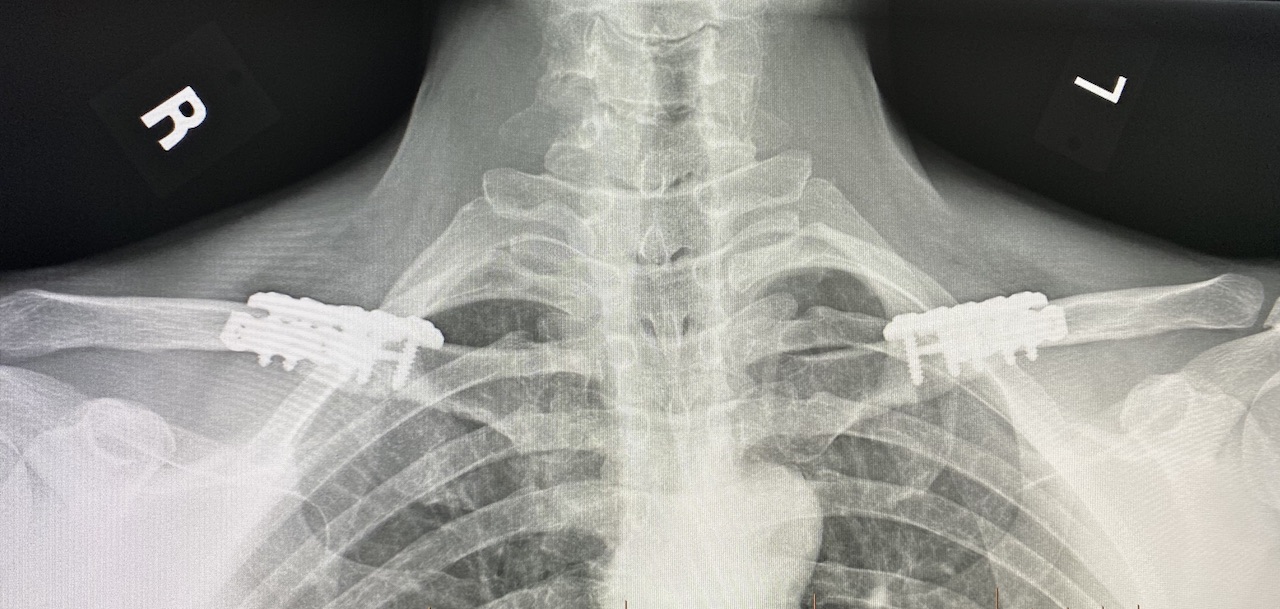 Plastic Surgery Case Study - Reductive Shoulder Reshaping Combined With ...