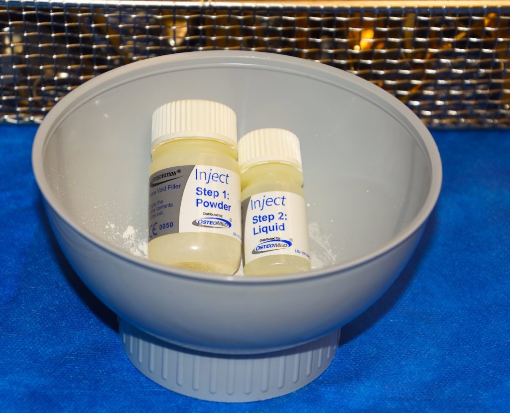 Technical Strategies - Hydroxyapatite Bone Cement in Orbital Floor/Rim ...