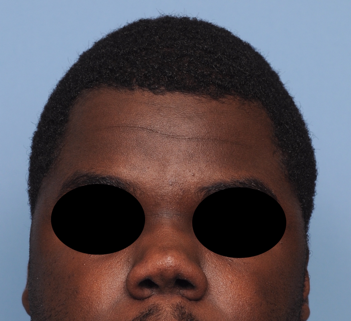 Plastic Surgery Case Study - Left Temporal Reduction For Side Of the ...