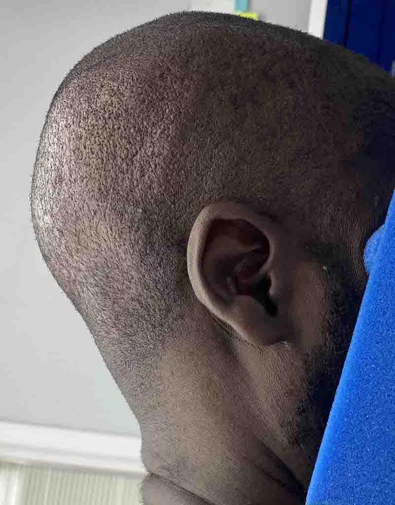 Plastic Surgery Case Study- Back of the Head Reshaping with Occipital ...