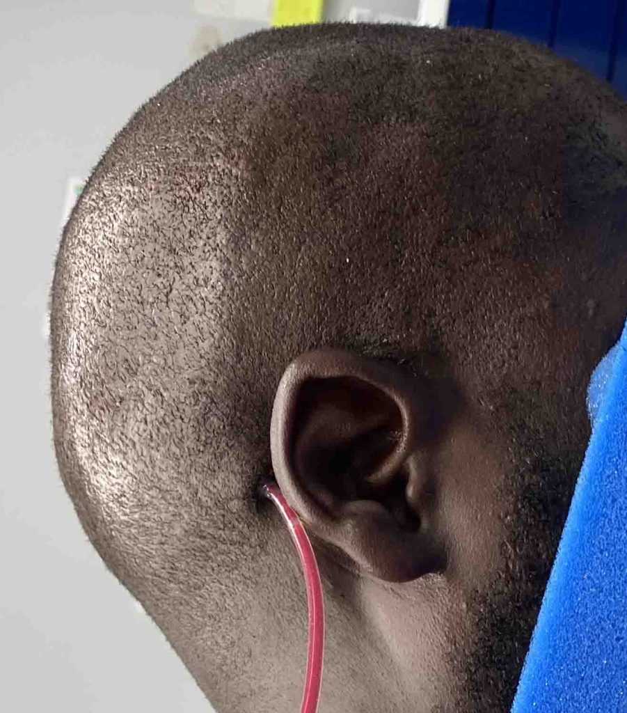 male back of head skull reshaping side 2 Dr Barry Eppley Indianapolis ...