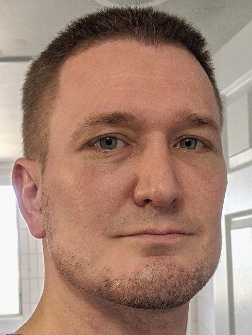 The Realities of Male Facial Masculinization Surgery Using Custom ...