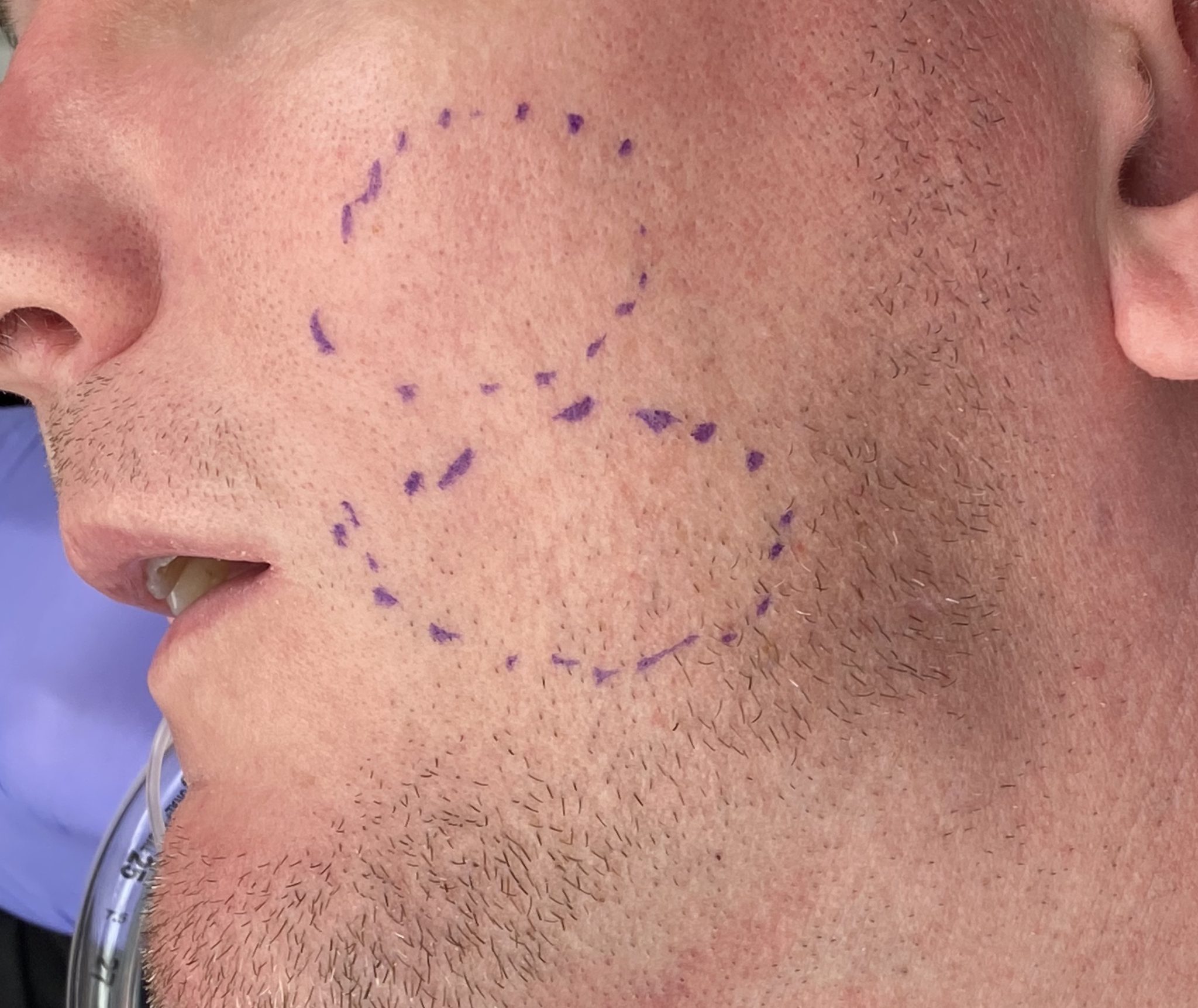 The Realities of Male Facial Masculinization Surgery Using Custom ...