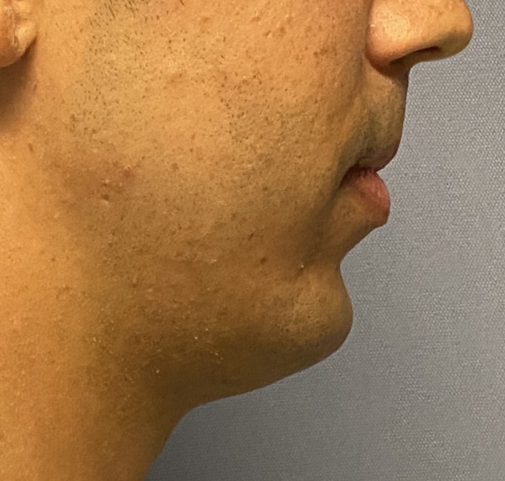 Plastic Surgery Case Study - Total Aesthetic Jaw Augmentation with A ...