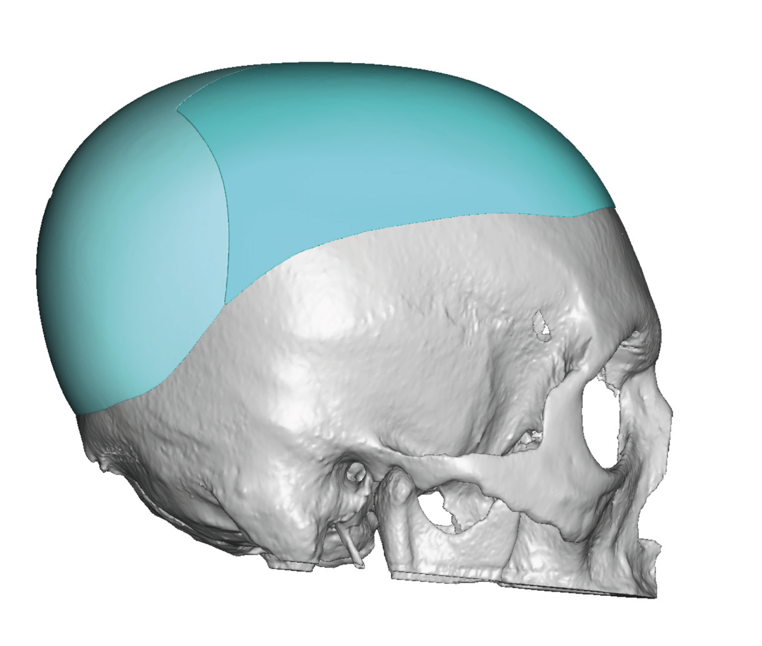 The Basic Concepts of the Two Stage 3D Skull Implant Augmentation ...