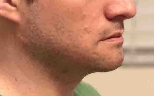 male sliding genioplasty and custom jaw implants oblique 1 Dr Barry ...