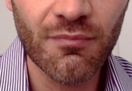 Plastic Surgery Case Study - The Aesthetic Benefits of Lengthening of ...