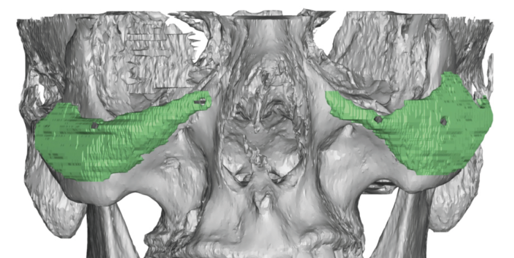 Plastic Surgery Case Study - Completion Custom Paranasal-Maxillary ...