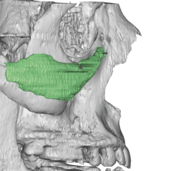 Plastic Surgery Case Study - Completion Custom Paranasal-Maxillary ...