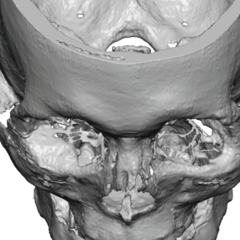 orbital reconstruction Archives - Explore Plastic Surgery