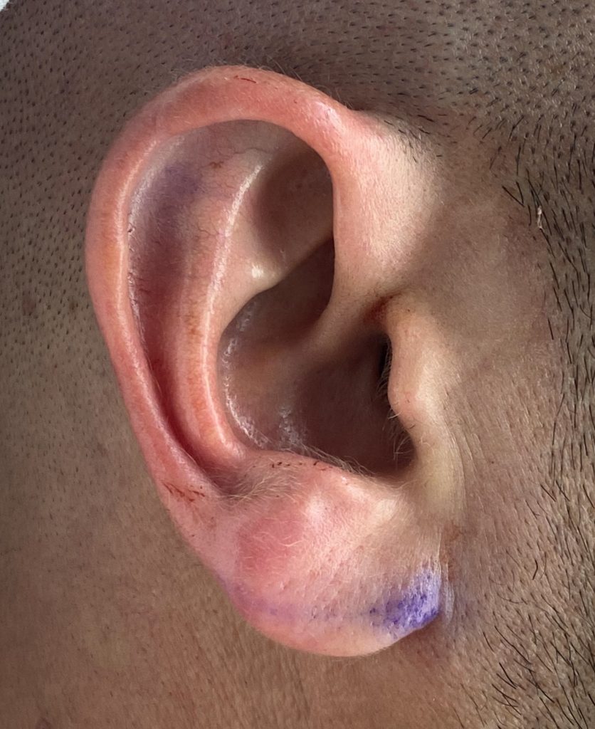 Plastic Surgery Case Study - Aesthetic Ear Reshaping Procedures in the ...