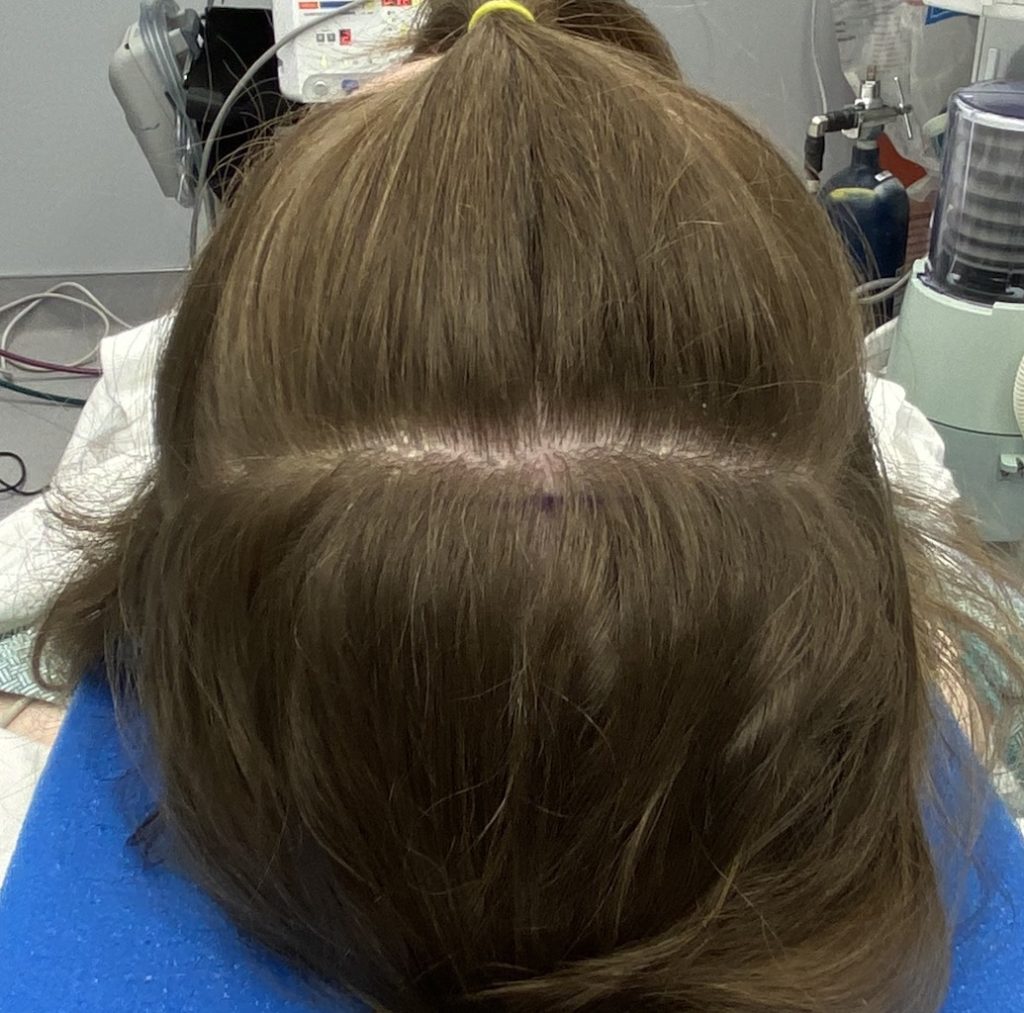 Plastic Surgery Case Study - Major Top of the Head Skull Reduction ...