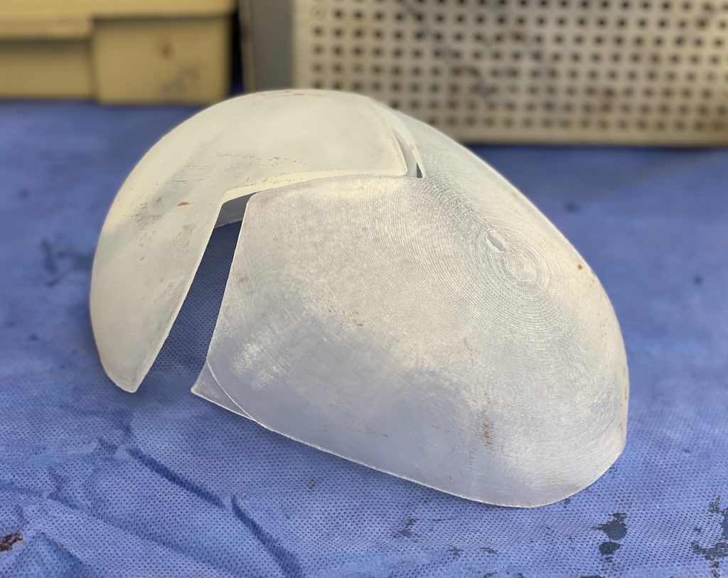 The Basic Concepts of the Two Stage 3D Skull Implant Augmentation ...