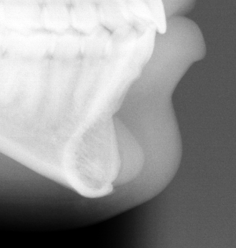 chin implant in proifle lateral ceph x-ray - Explore Plastic Surgery