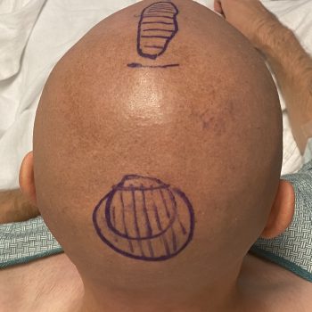 skull reshaping Archives - Explore Plastic Surgery