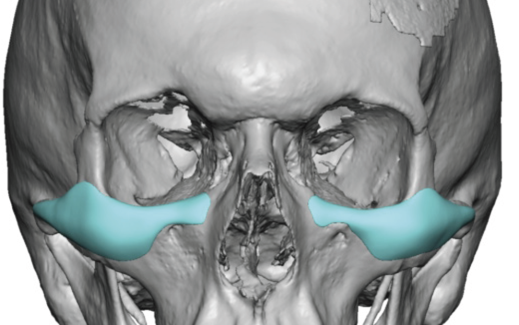 The Lower Eyelid Incision Used In Custom Infraorbital Rim-Malar ...