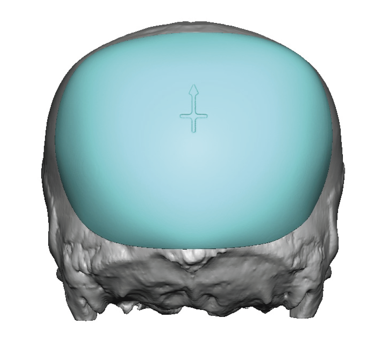 Plastic Surgery Case Study - Total Flat Back Of Head Reshaping With ...