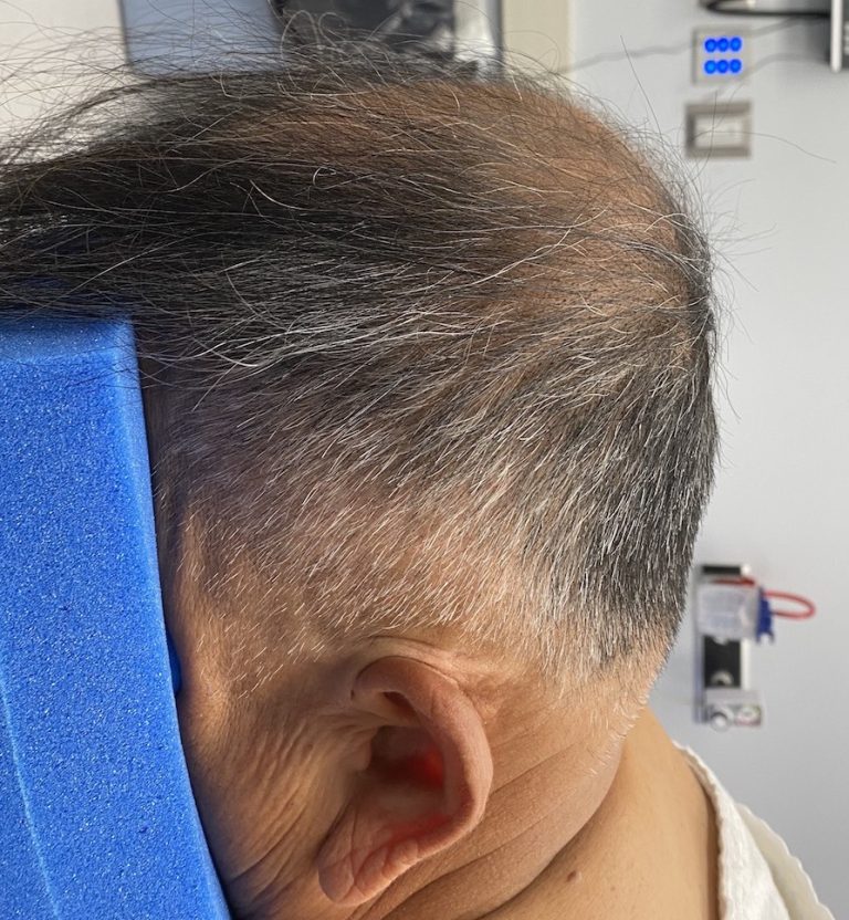 Plastic Surgery Case Study - Total Flat Back Of Head Reshaping With ...